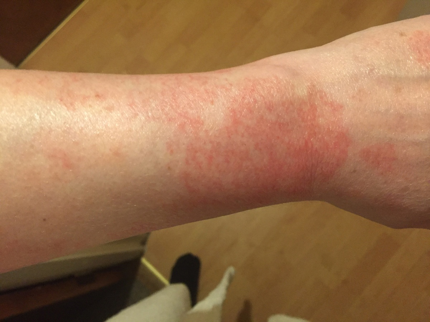 Mum who thought skin rash was eczema discovers it's actually rare ...
