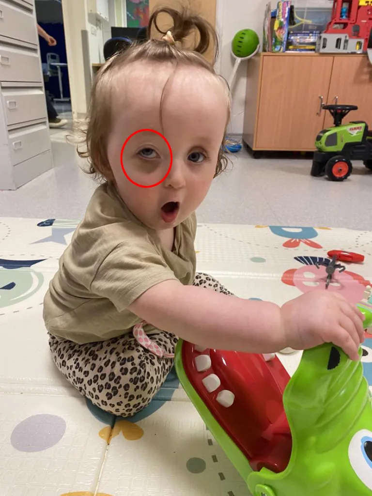 ‘Bruise on my baby’s eye turned out to be CANCER,’ reveals heartbroken ...