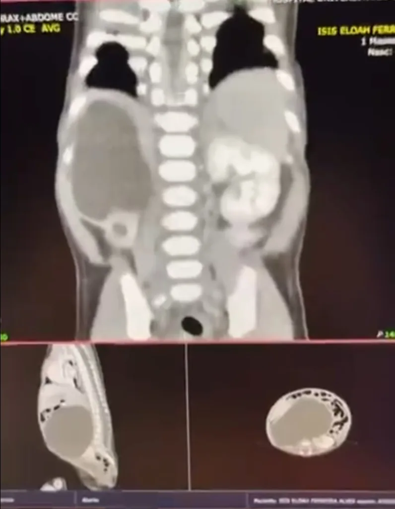 Baby born with four kidneys in exceedingly-rare case - Need To Know