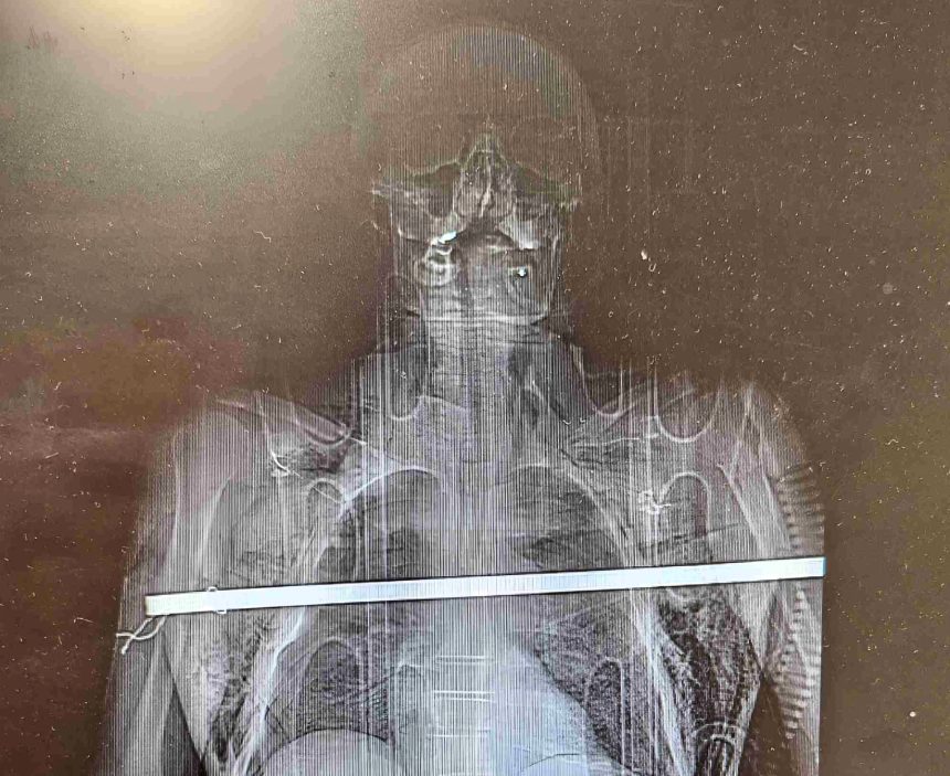 Man miraculously survives being impaled by huge iron rod in freak ...