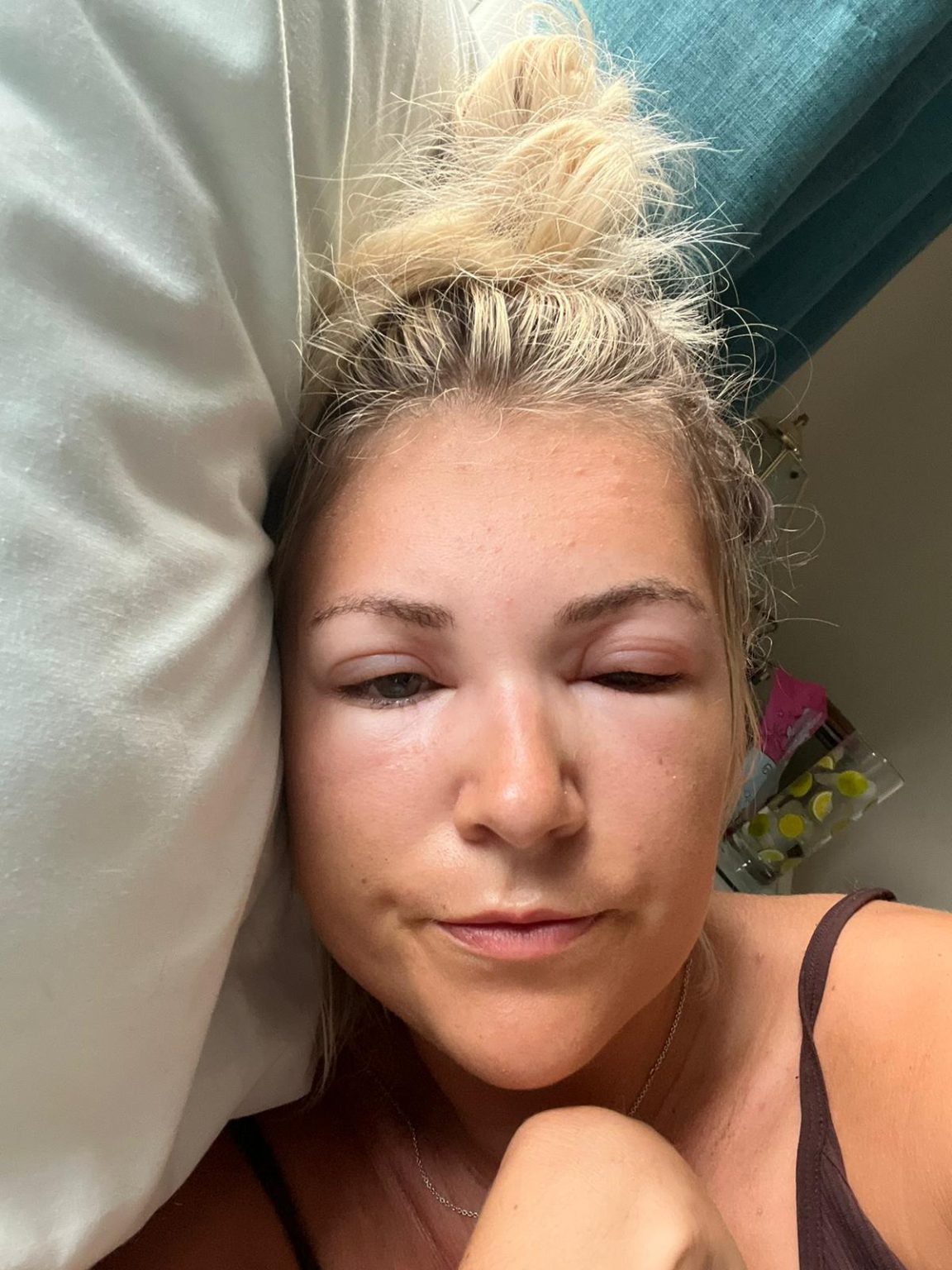 British woman, 24, rushes to hospital with extreme sun poisoning after ...