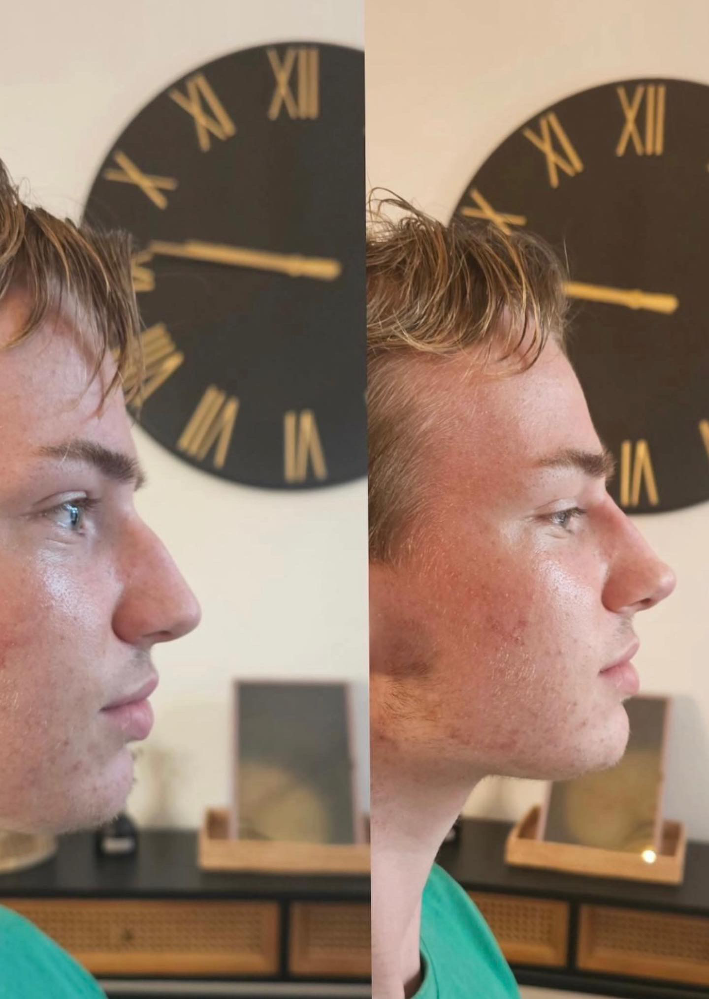 Teen goes viral as nose begins LEAKING pink fluid after botched filler ...