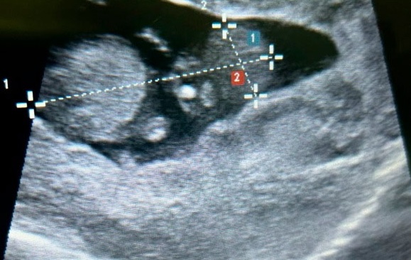Woman suffers ectopic pregnancy in LIVER in ‘extremely rare case ...