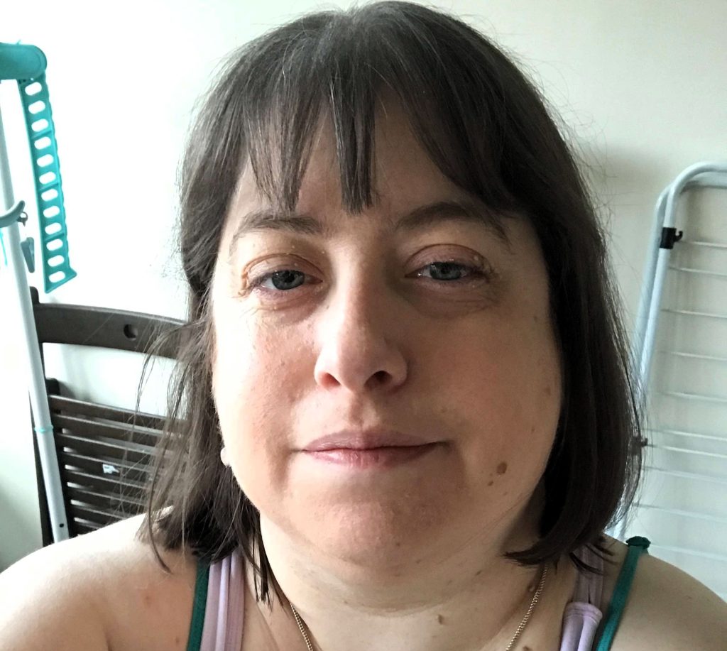 ‘My rare vampire disease means my kids think I’m a Twilight character ...