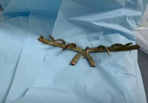 Claw hair clip embedded in woman’s scalp after horror car smash | Need ...