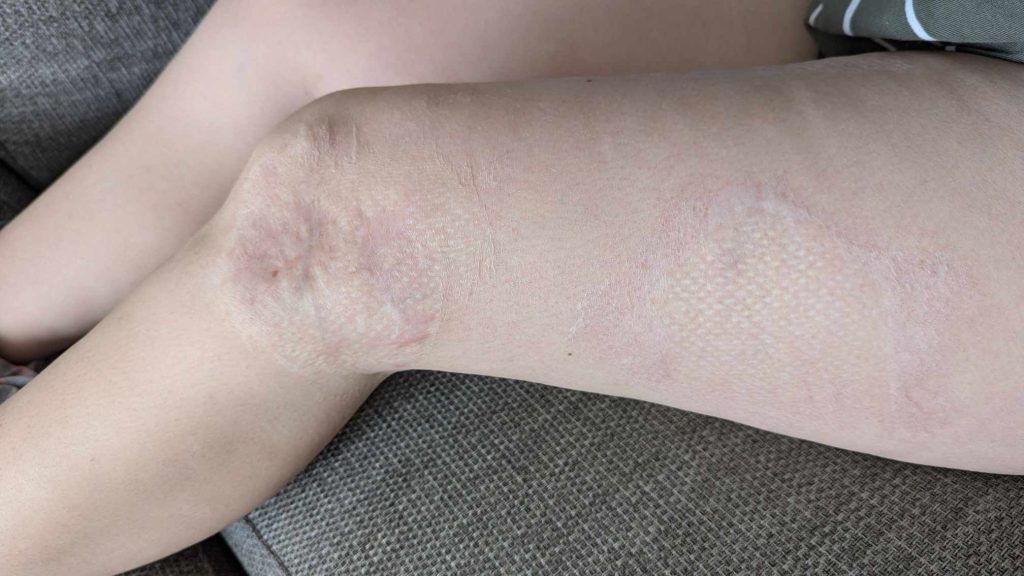 ‘Vape caught FIRE in my pocket – my leg was burnt to a crisp’ | Need To ...