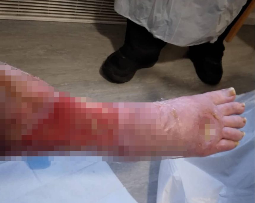 Mum has chunks of leg cut away after UTI turns out to be FLESH-EATING ...