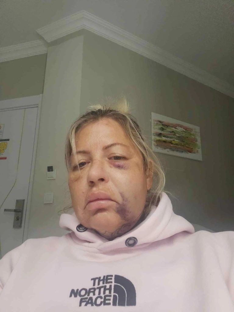 Mum-of-three ‘nightmare’ £10,000 Turkey teeth makeover is worst thing ...