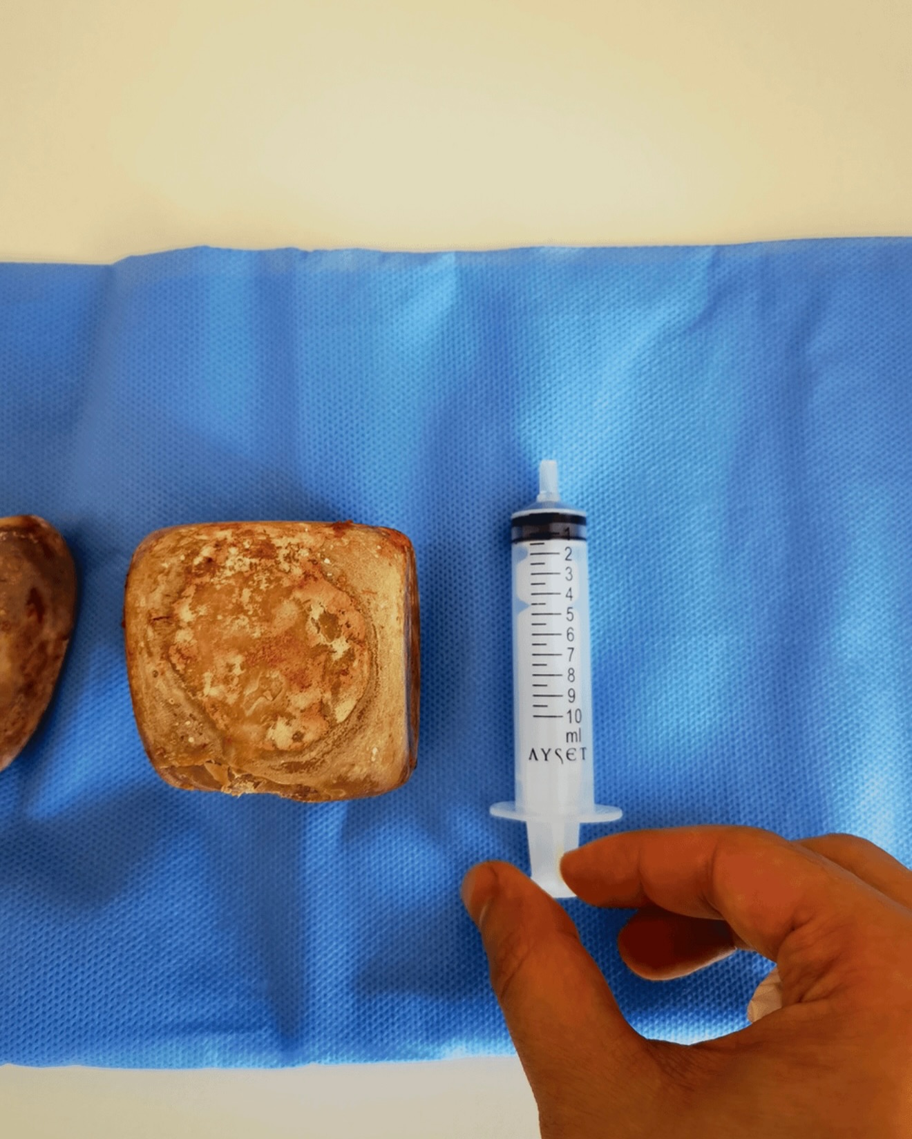 Doctors shocked to find huge pyramid-shaped stones in man’s bladder ...