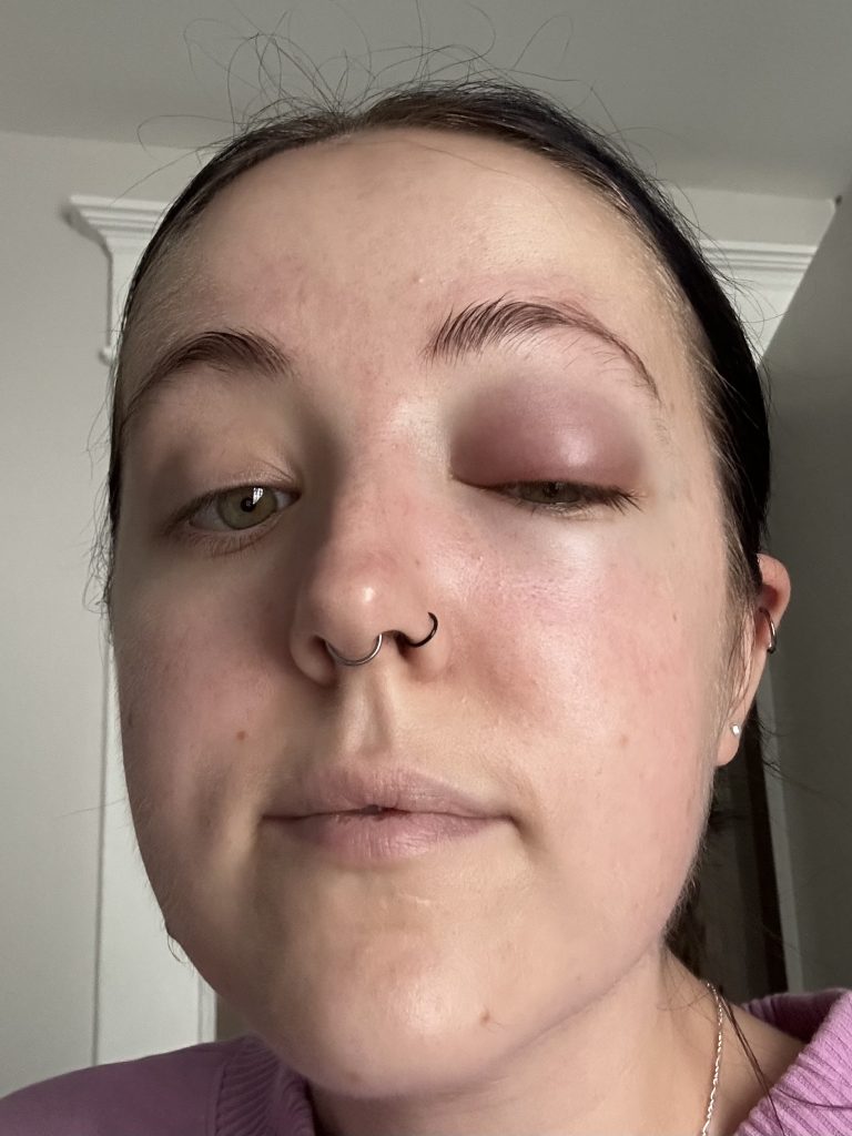 ‘I found a new lump on my body every day for a week – the cause was ...