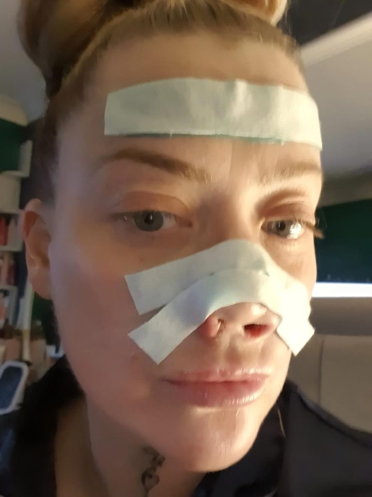 Mum’s ‘face collapsed’ after botched dental implants in Turkey | Need ...