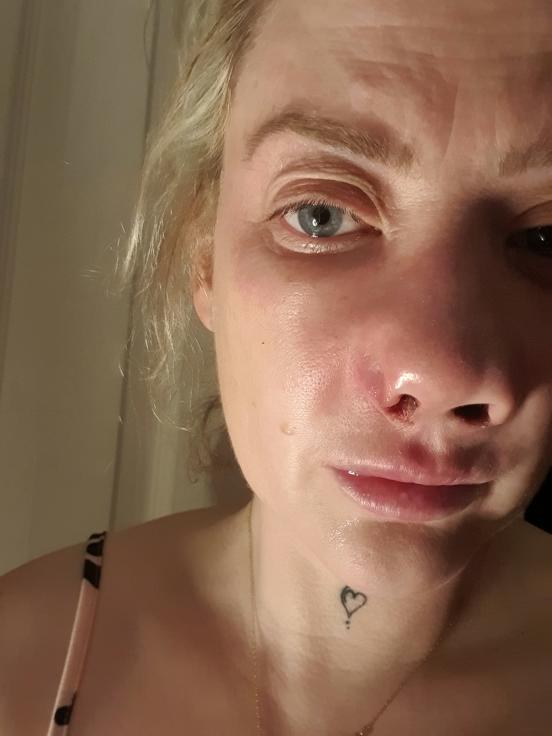 Mum’s ‘face collapsed’ after botched dental implants in Turkey | Need ...