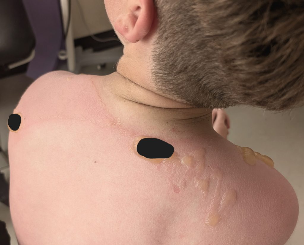 Dad fuming as boy, 12, comes home with second-degree burns from school ...