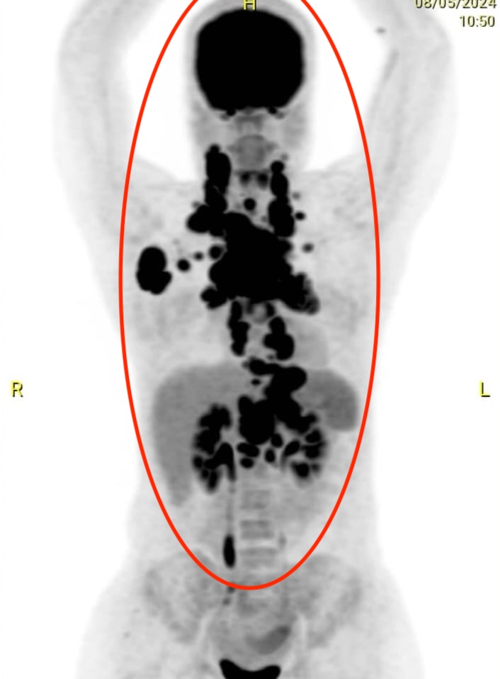 ‘I was given 24 hours to live after X-ray showed aggressive cancer ...