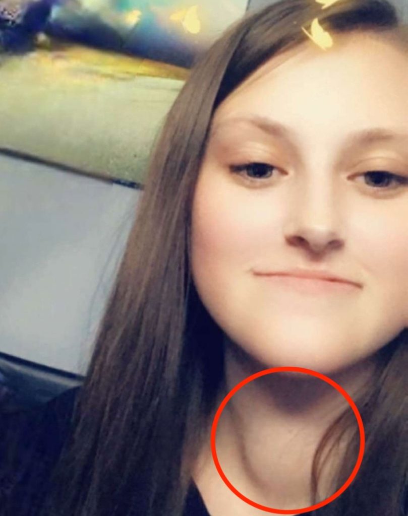 Woman, 25, battling golf-ball-sized neck lump says it’s ‘taken ...