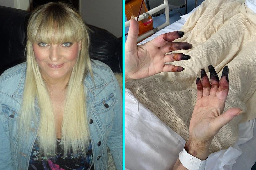‘My fingers and toes turned BLACK after small kidney stone wrought ...