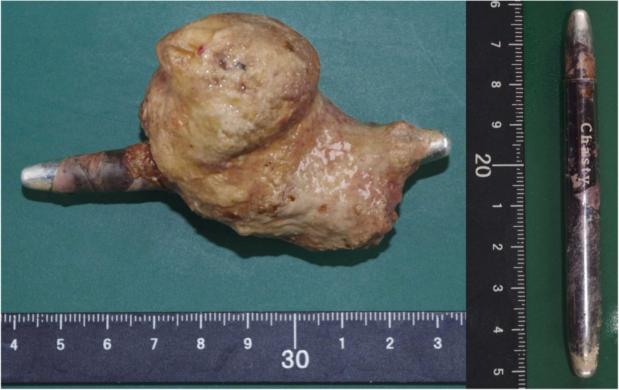 Stunned doctors find giant bladder stone stuck to eyeliner in man’s bum ...