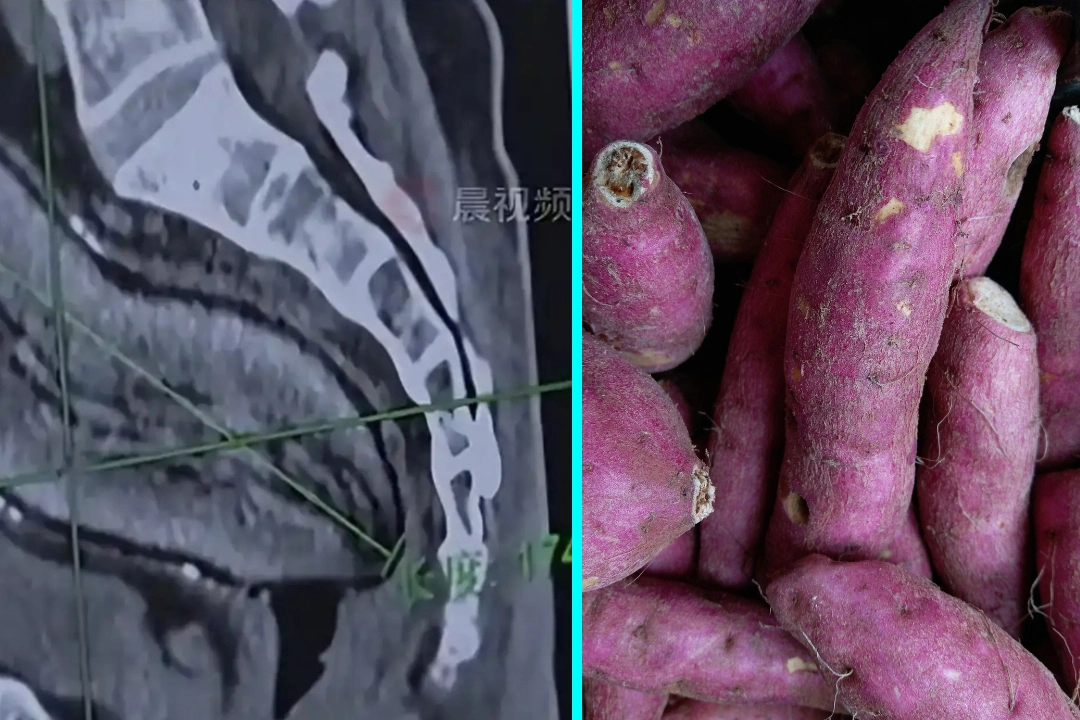Stunned surgeons remove huge spud from man’s bum | Need To Know