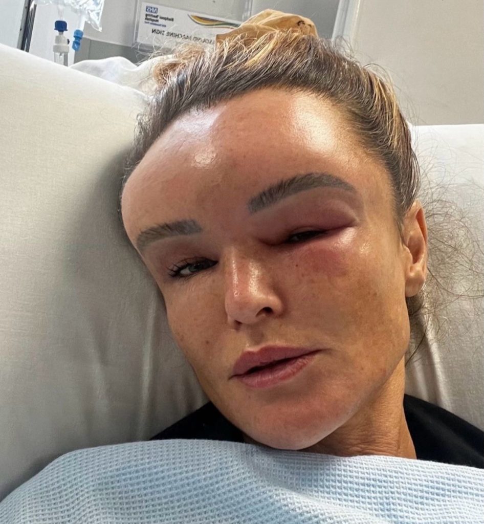 Teacher ‘unrecognisable’ as rare condition causes extreme facial ...